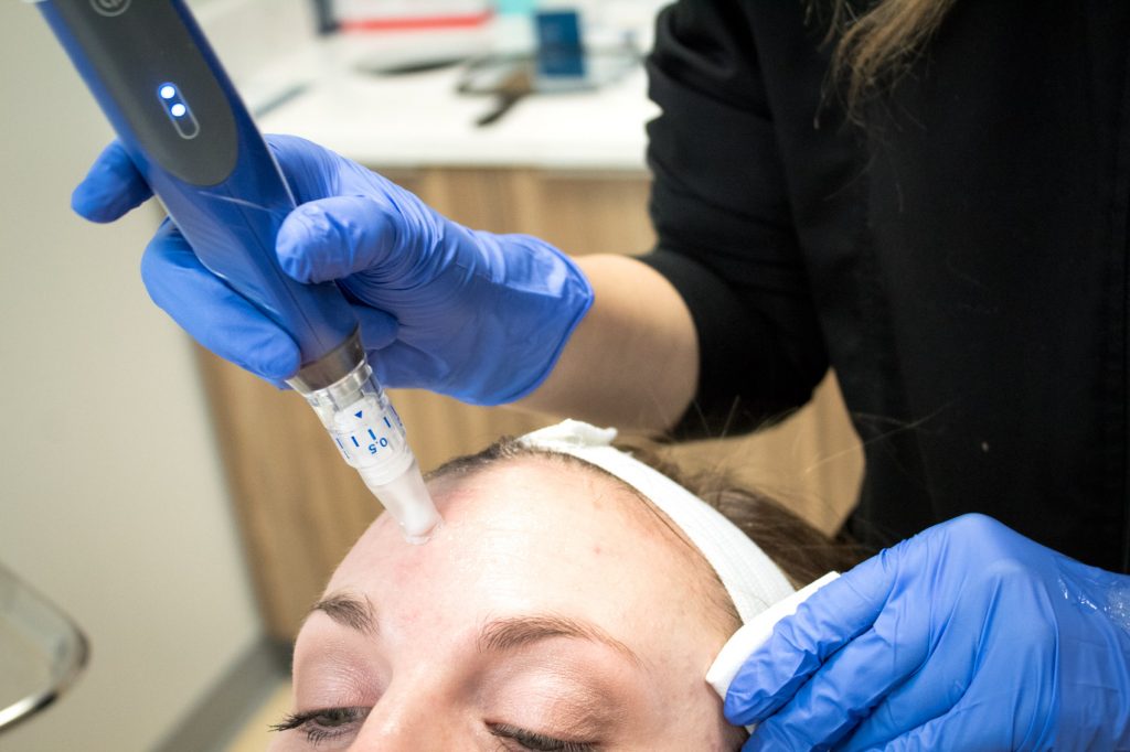 My Microneedling Experience + Did It Work for Acne Scars? - Allyn Lewis