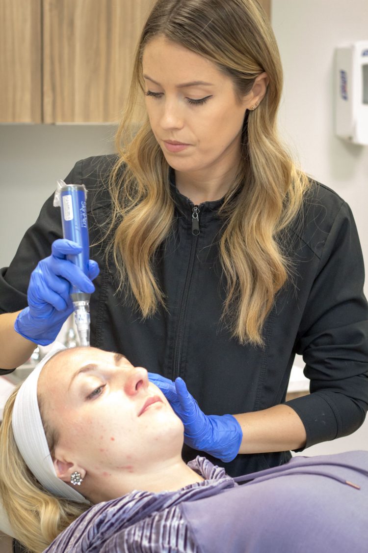 My Microneedling Experience + Did It Work for Acne Scars? - Allyn Lewis